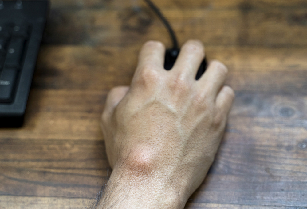 Common Lumps on the Body: Causes, Types, and When to See a Doctor - Be ...