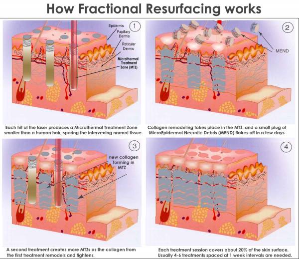 Four Treatments for Actinic Keratosis - Be Your Best, Well, Self