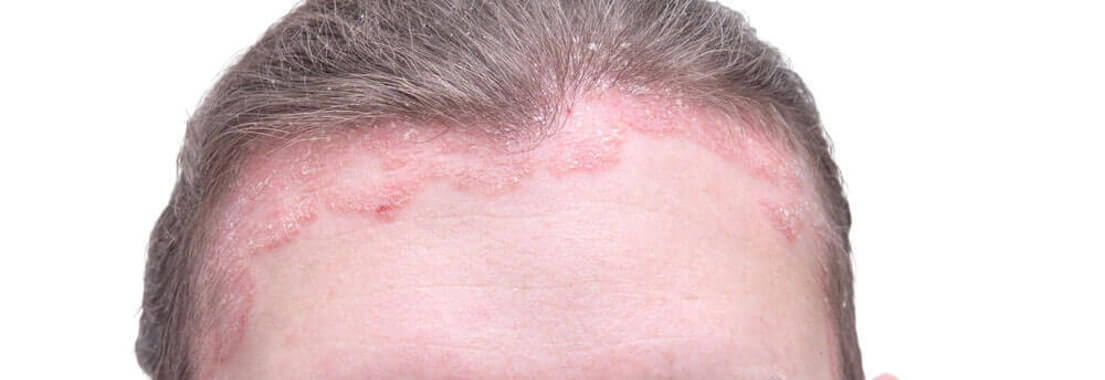 9 Types of Psoriasis: Pictures, Symptoms, Triggers, Diagnosis and ...