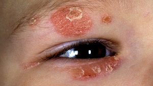Facial Psoriasis: Symptoms, Causes & 10 Best Treatment Options in 2021 ...