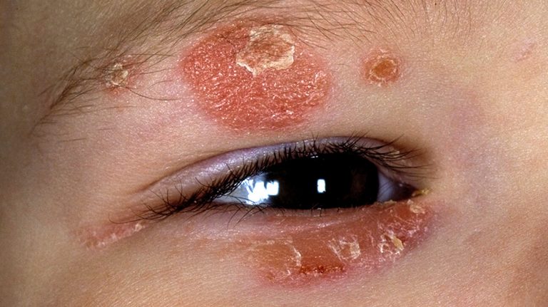 Facial Psoriasis: Symptoms, Causes & 10 Best Treatment Options in 2021 ...