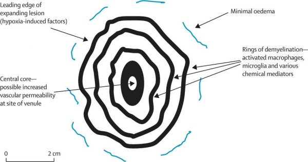 Balo Disease Symptoms, Diagnosis and Best Treatment in 2021 - Be Your ...