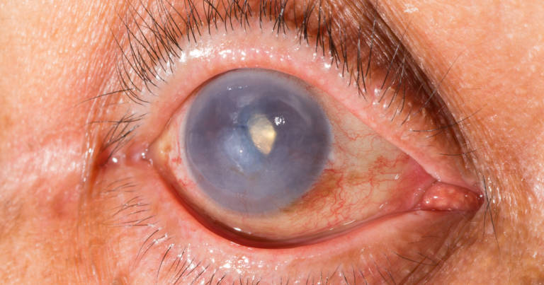 Eye Pain: Causes Symptoms and Treatment - Be Your Best, Well, Self