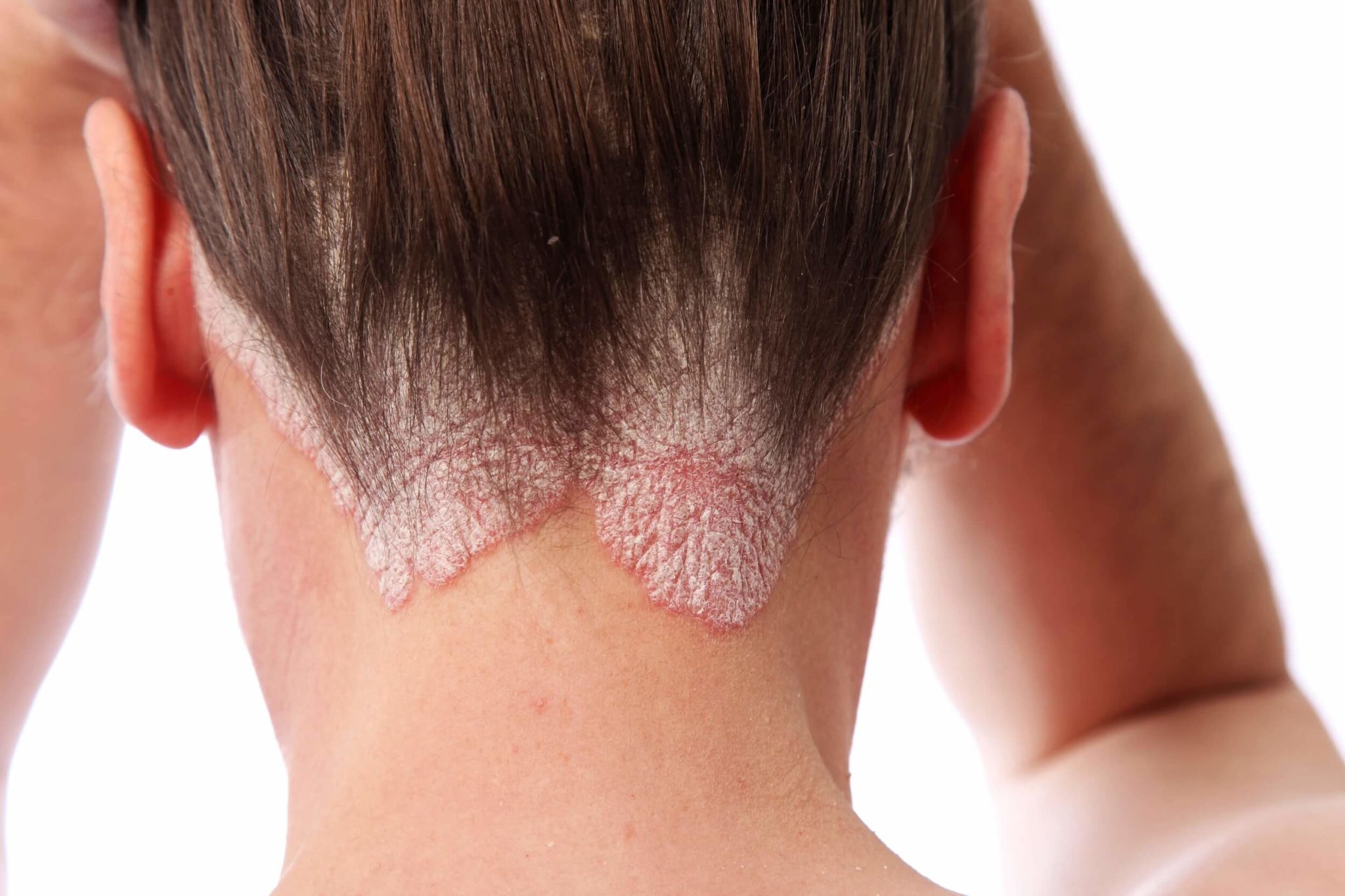 9 Types of Psoriasis: Pictures, Symptoms, Triggers, Diagnosis and ...